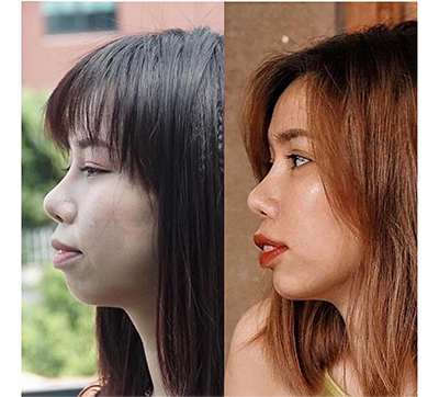 HIFU Treatment At Mayu Spa Ho Chi Minh City - Mayu Esthetic Japanese Spa